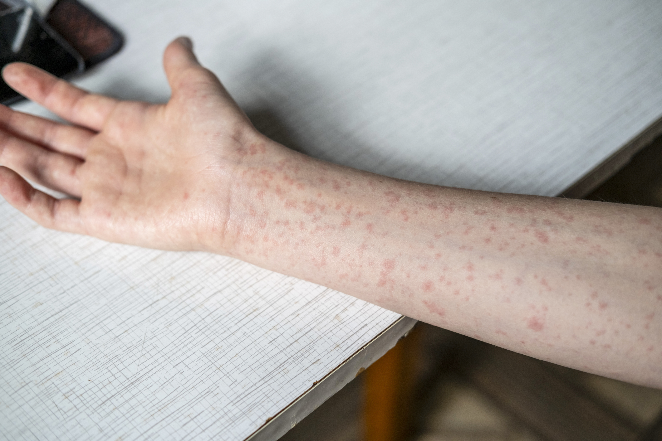 Response to increasing measles cases - NEPHU adult measles immunisation ...